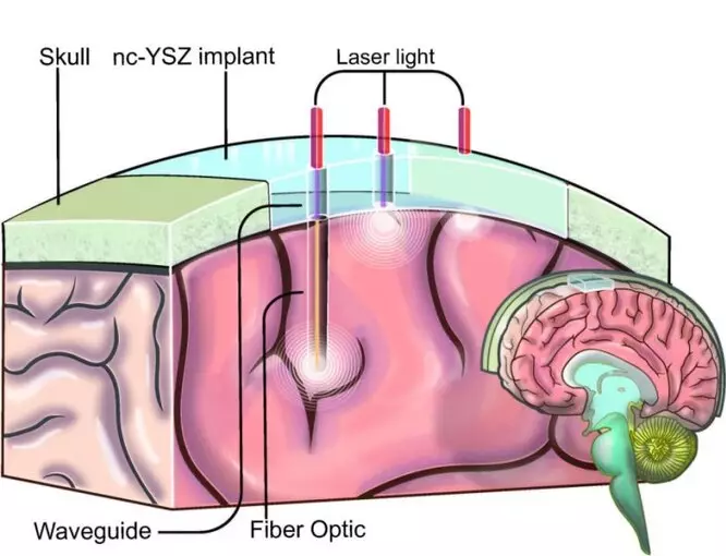 Glapinski mozak: prozirni šernogo implantat 341563_3